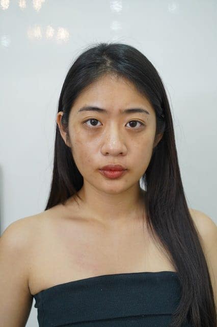 Tại sao tổ hợp Meso-RBA lại hot đến vậy?