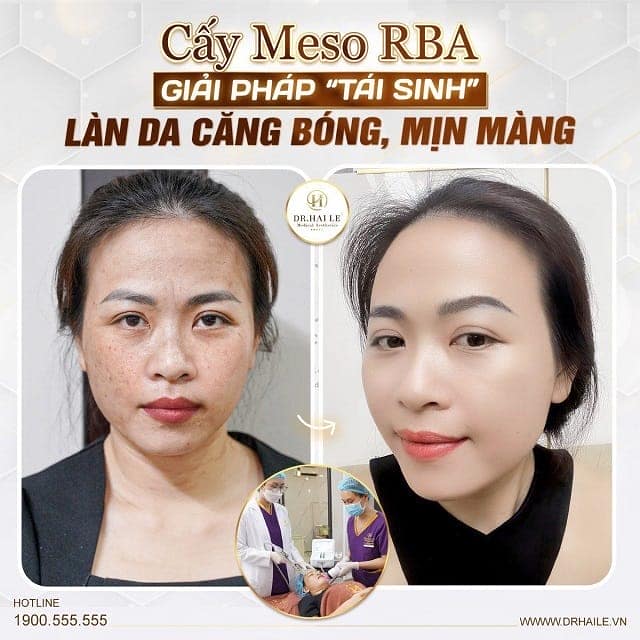 Meso - RBA giải quyết mọi vấn đề về da có gì hot?