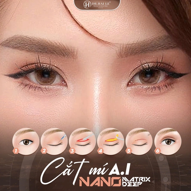 Cắt mí A.I Nano matrix Deep